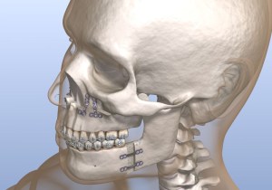 How Oral Surgeons Treat Jaw Misalignment: Options Beyond Braces